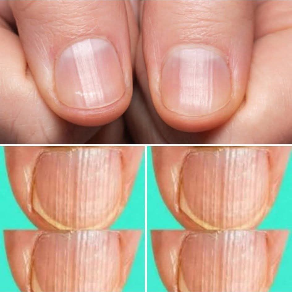 Rippled fingernails reveal secrets of possible disease - Story